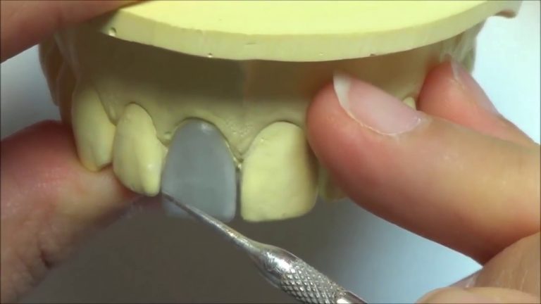 What is Diagnostic Wax Up? | Waterstone Family Dentistry